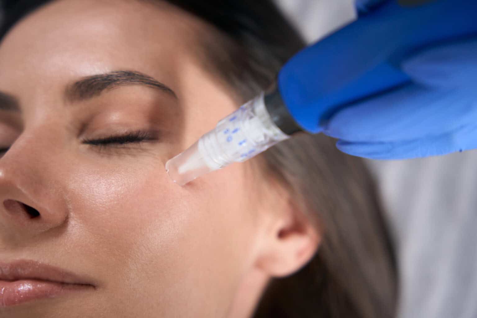 Cool Peel Generation of Noninvasive Skin Treatments